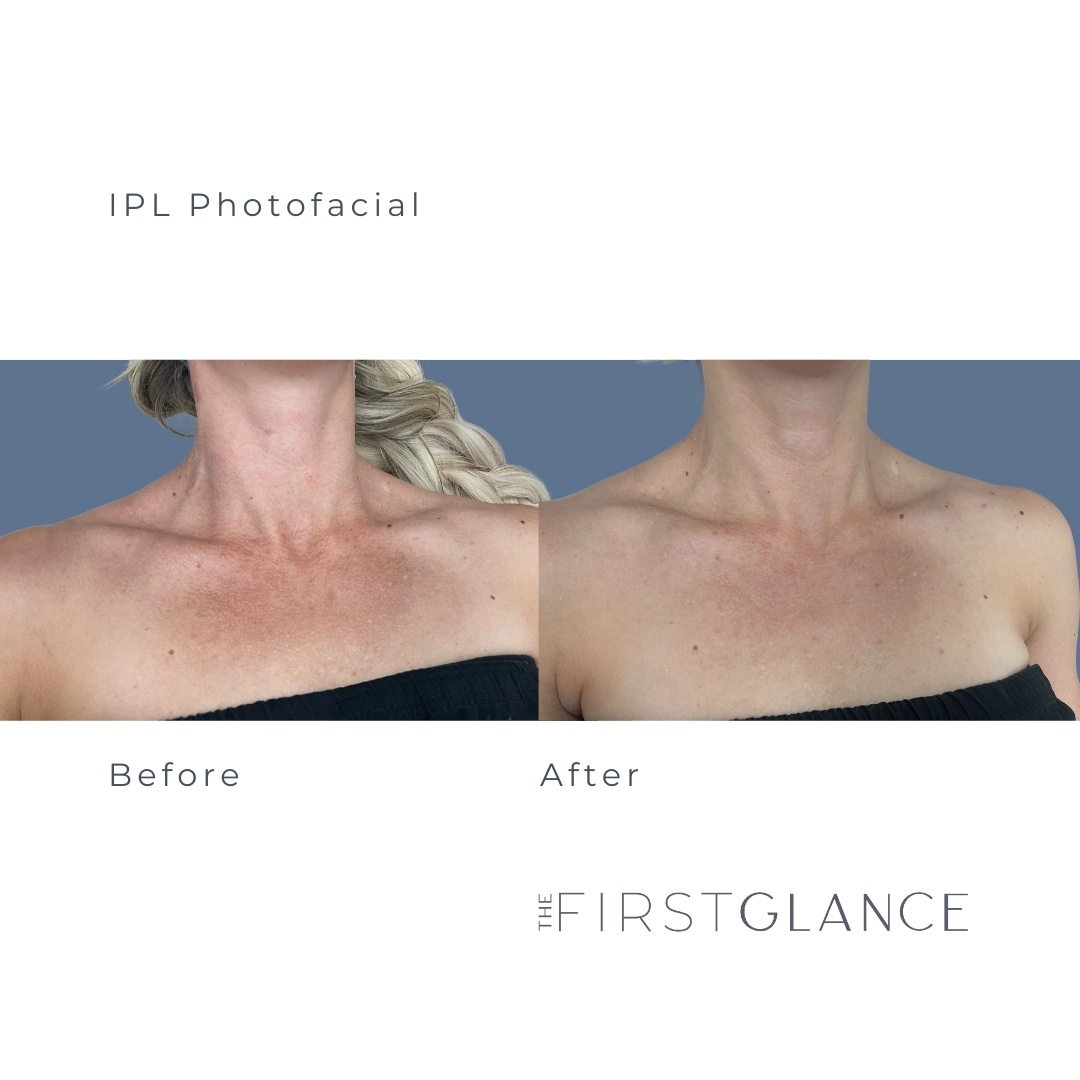 IPL Photofacial | Before & After Photos | Winnipeg | The First Glance